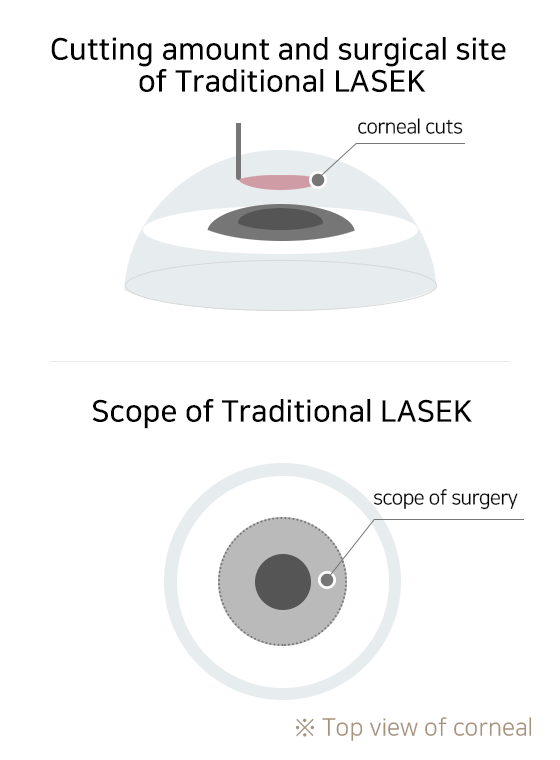 Lasek Procedure